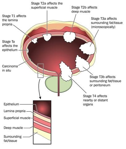 Bladder Cancer Staging and Grading